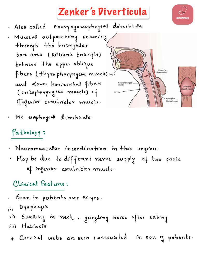 Zenker's Diverticula | PDF