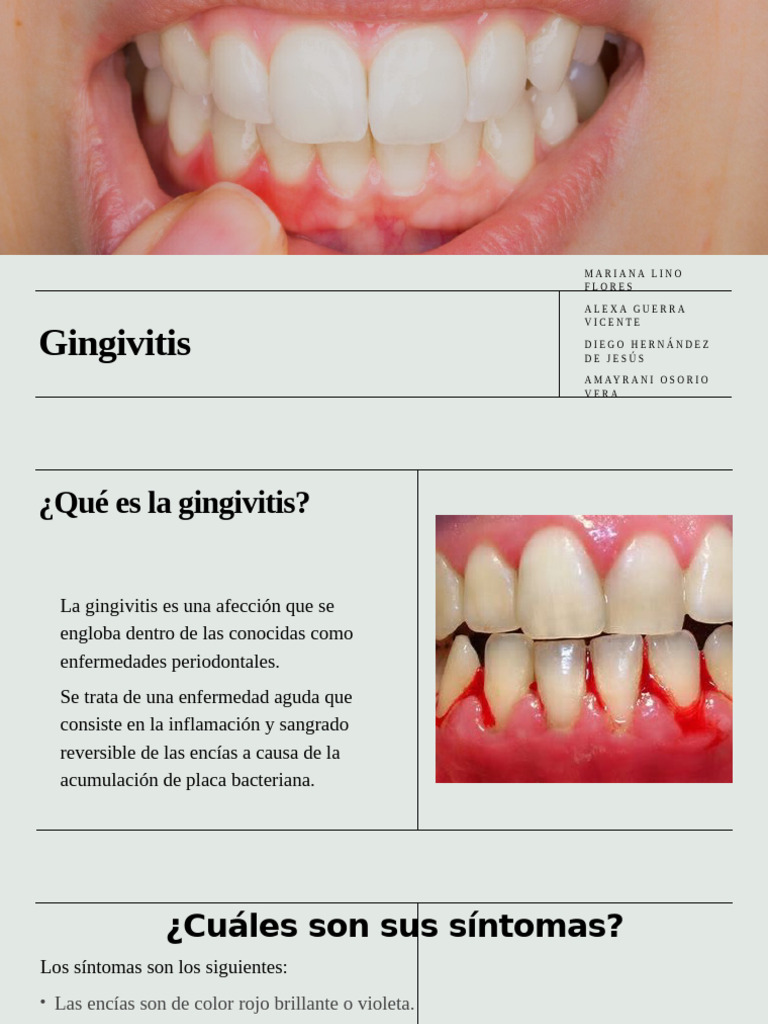 Gingivitis | PDF