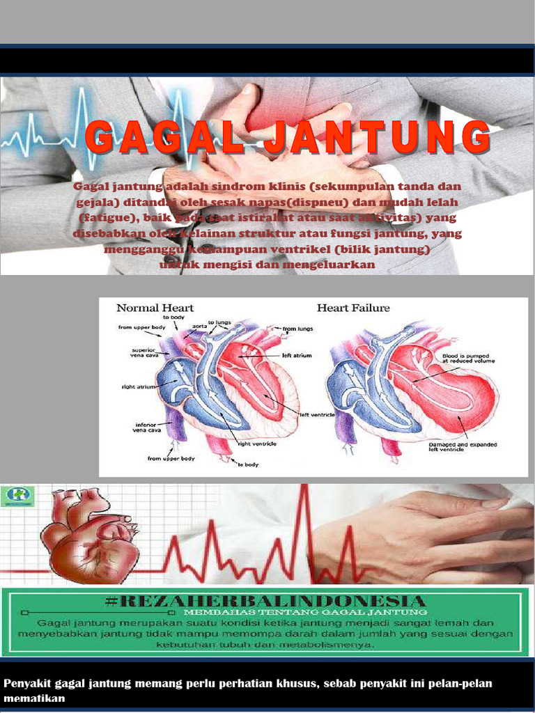 Flipchart Gagal Jantung Jua Gubali | PDF
