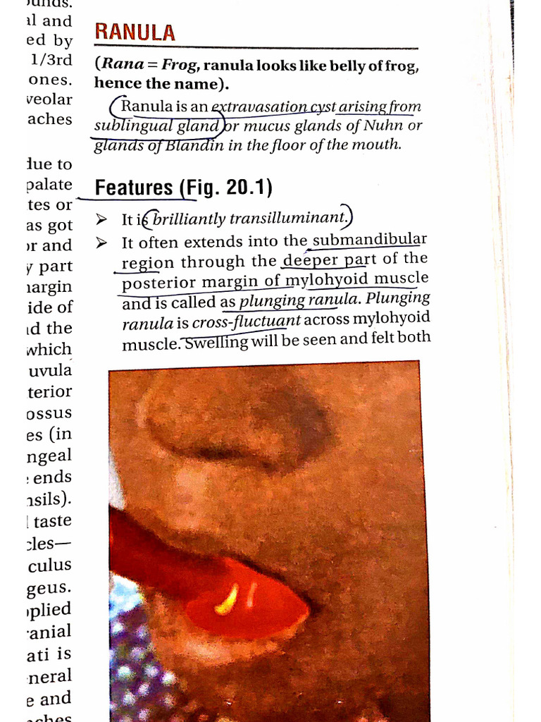Ranula | PDF