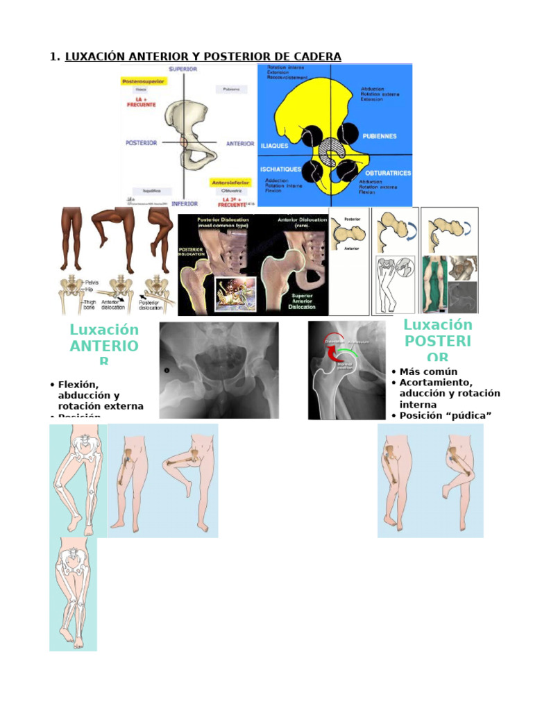 Luxación Anterior y Posterior de Cadera | PDF