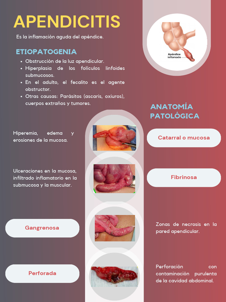 Apendicitis Aguda | PDF