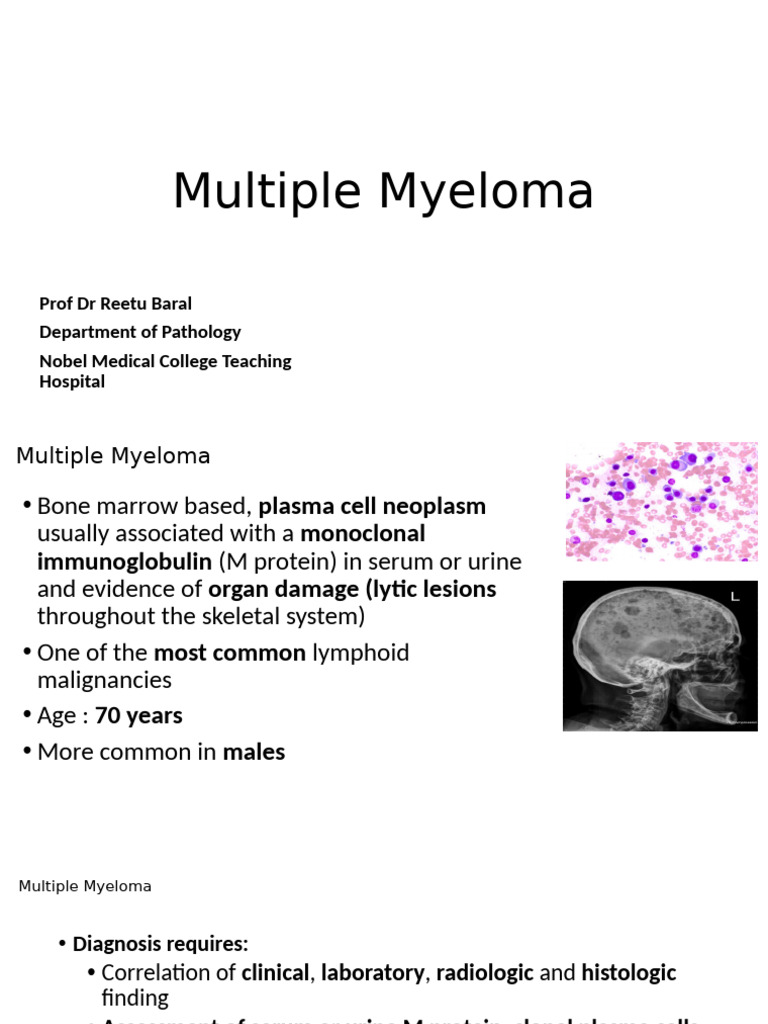 Multiple Myeloma | PDF