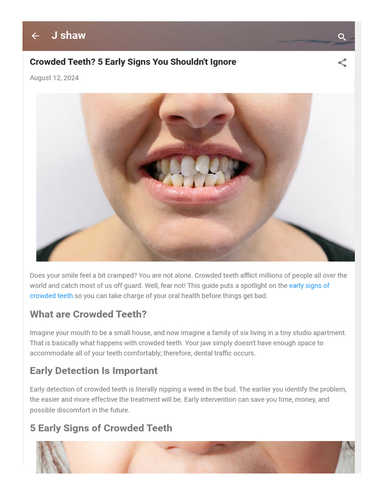 Crowded Teeth 5 Early Signs You Shouldn't Ignore | PDF | Human Tooth ...