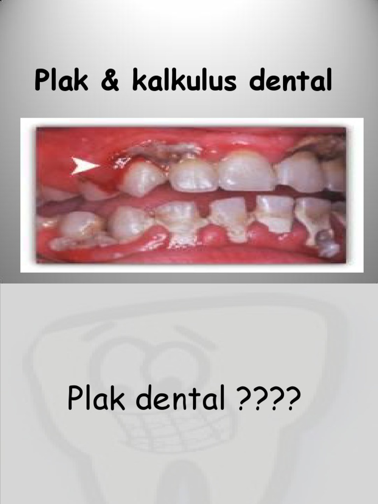 Penyuluhan Plak & Kalkulus Dental | PDF