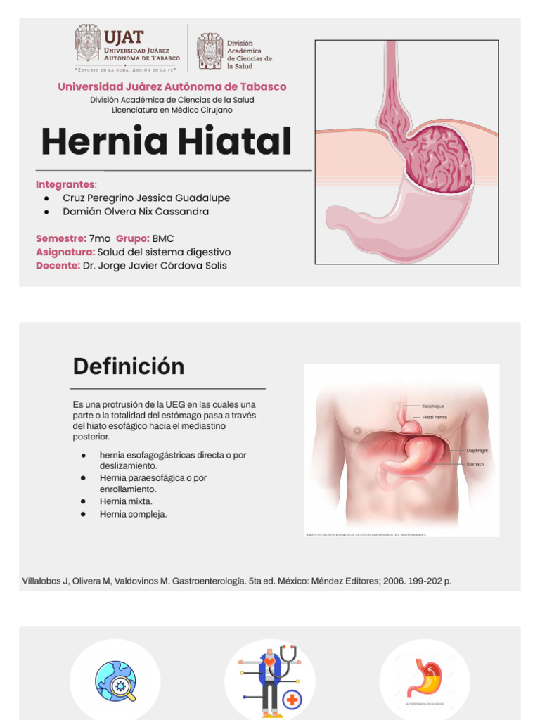 Hernia hiatal | PDF