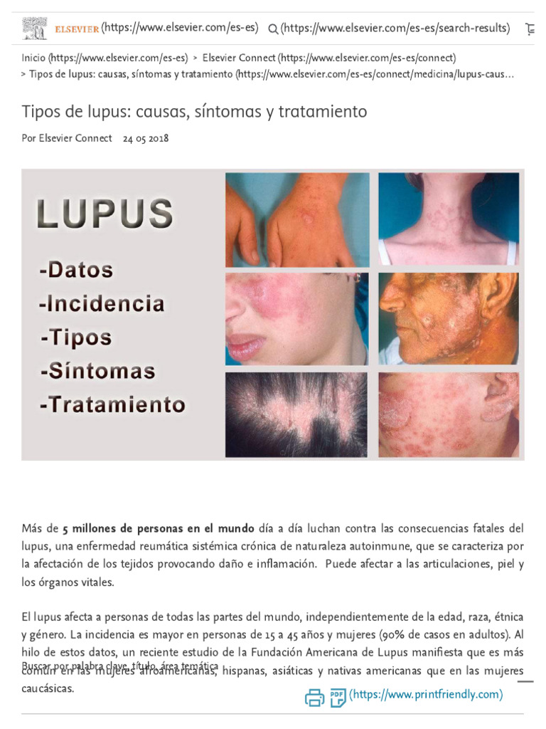 35 Tipos de Lupus Causas, Síntomas y Tratamiento | PDF