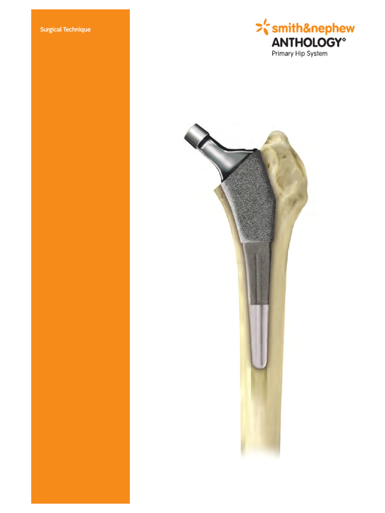 Smith - Nephew Anthology Surgical Technique | PDF