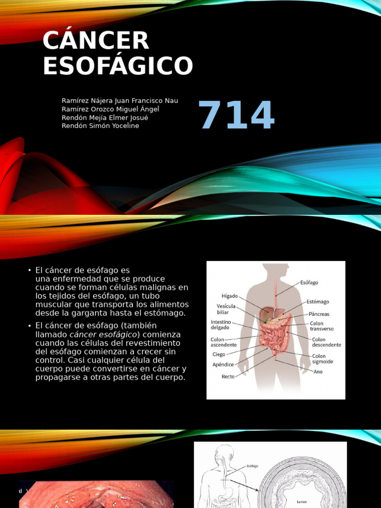 Cáncer ESOFÁGICO | PDF