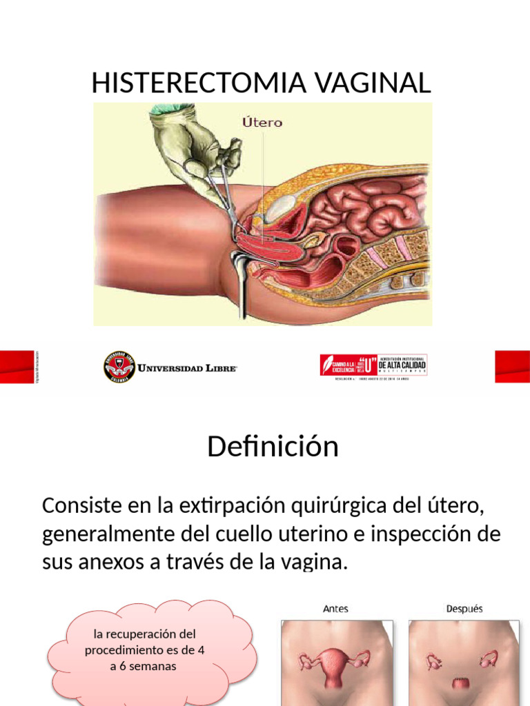 diapositivas de histerectomia vaginal | PDF