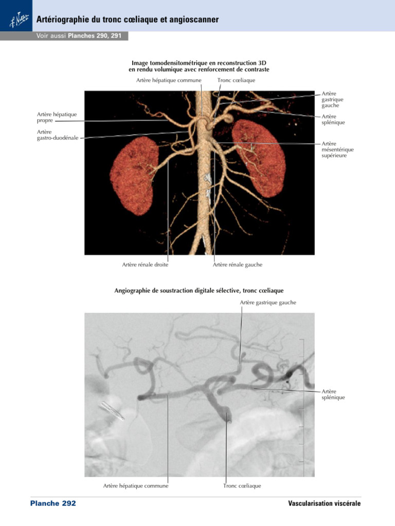 Artériographie Du Tronc Coeliaque Et Angioscanner | PDF