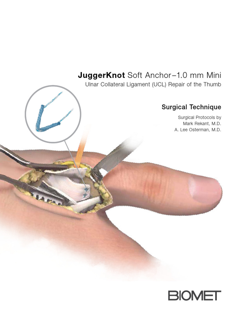 juggerknot-mini-ucl-repair-of-the-thumb-surgical-technique | PDF