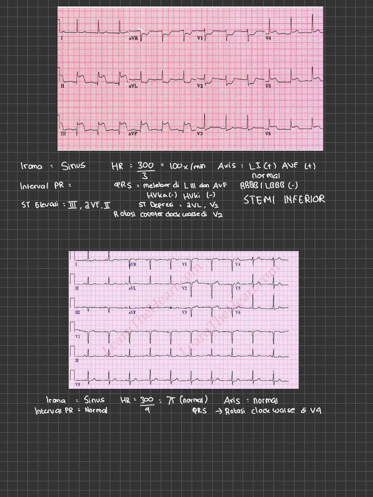 Belajar Ekg | PDF