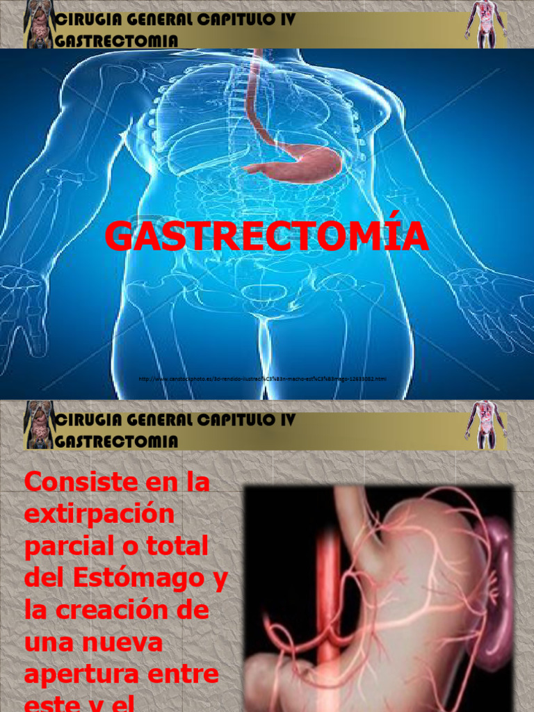 Gastrectomía Total 5 | PDF