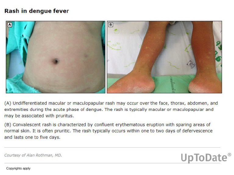 Dengue Rash | PDF