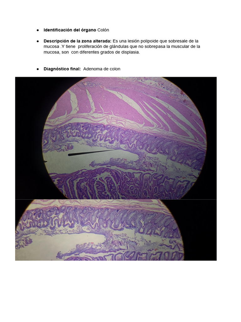MiCro Neoplasia - 1 | PDF
