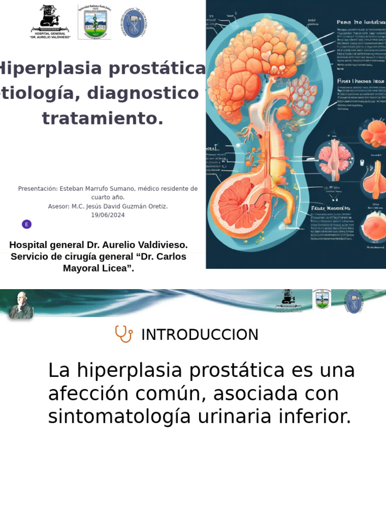 Hiperplasia Prostática Etiologia Diagnostico y Tratamiento. | PDF