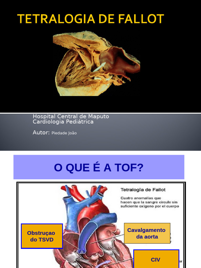 TETRALOGIA DE FALLOT Corrigida | PDF