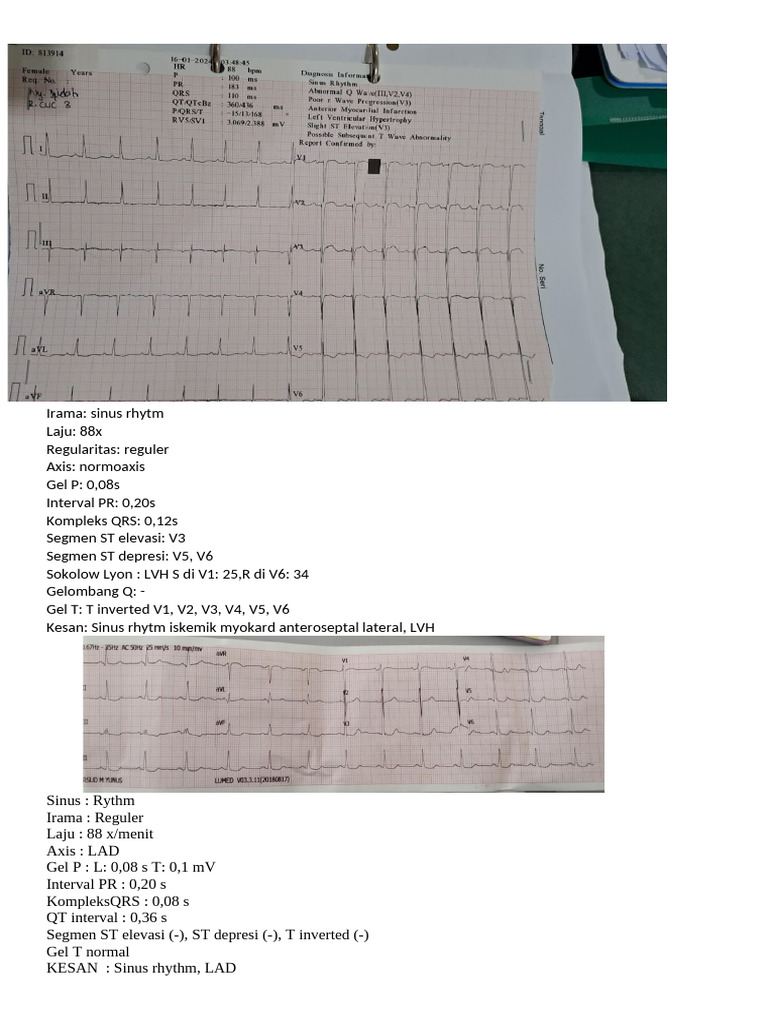 PR Ekg Cip | PDF