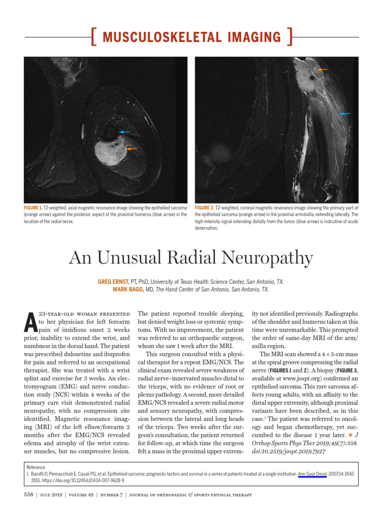 An Unusual Radial Neuropathy | PDF