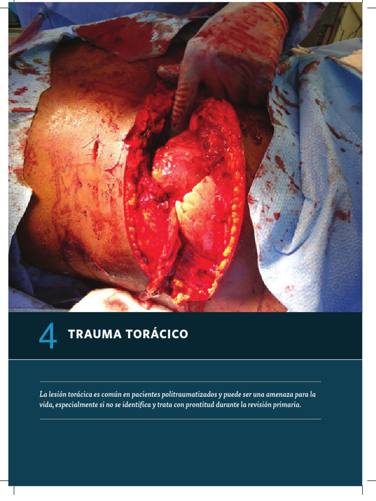 Trauma Torácico ATLS | PDF