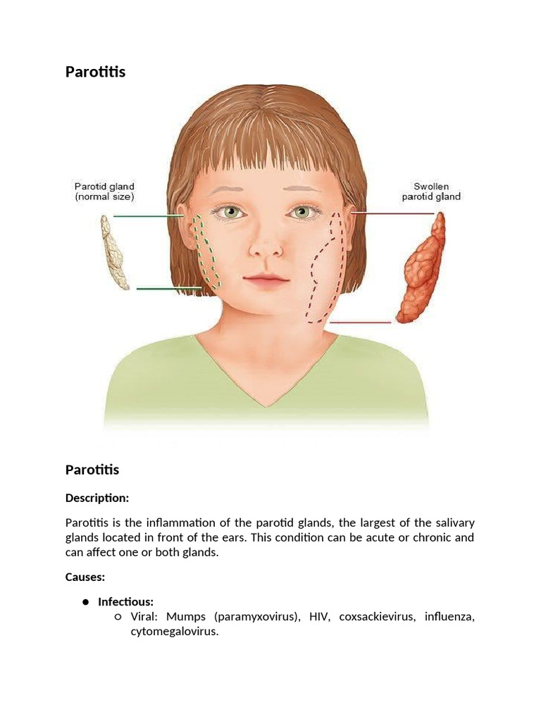 Parotitis | PDF