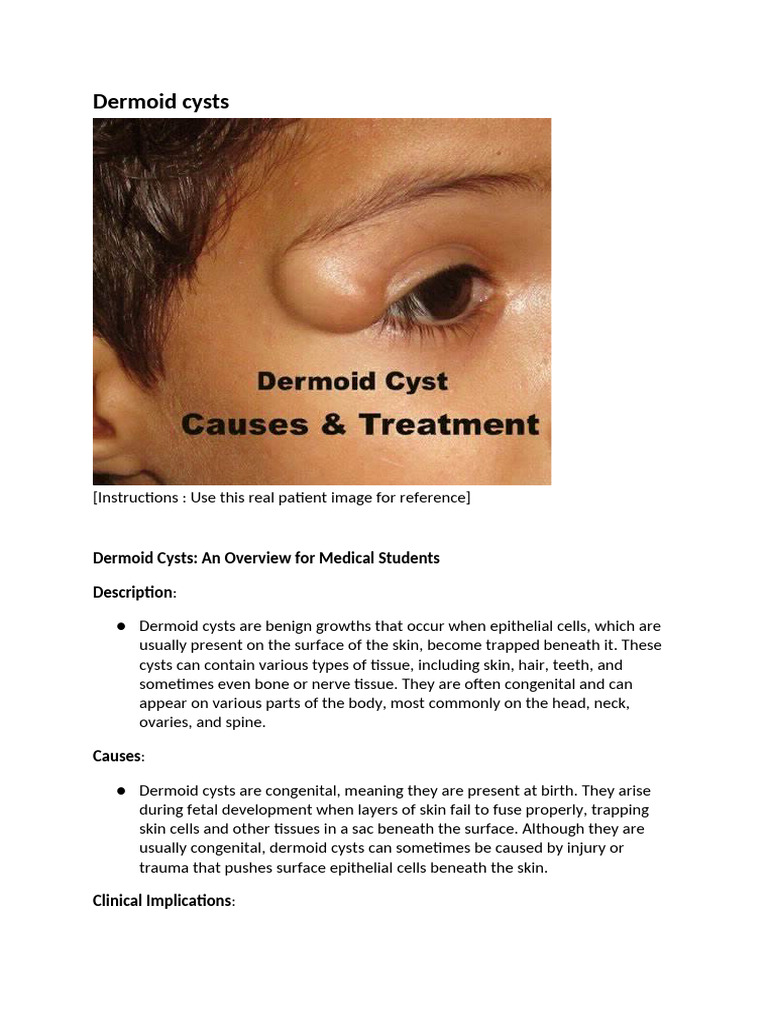 Dermoid Cysts | PDF