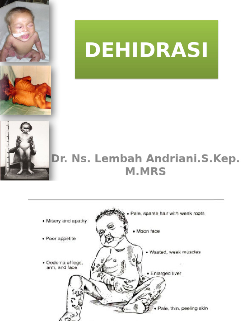 Dehidrasi Anak | PDF