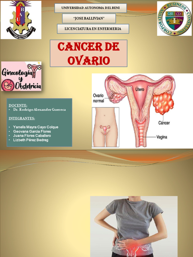 Cancer de Ovario | PDF