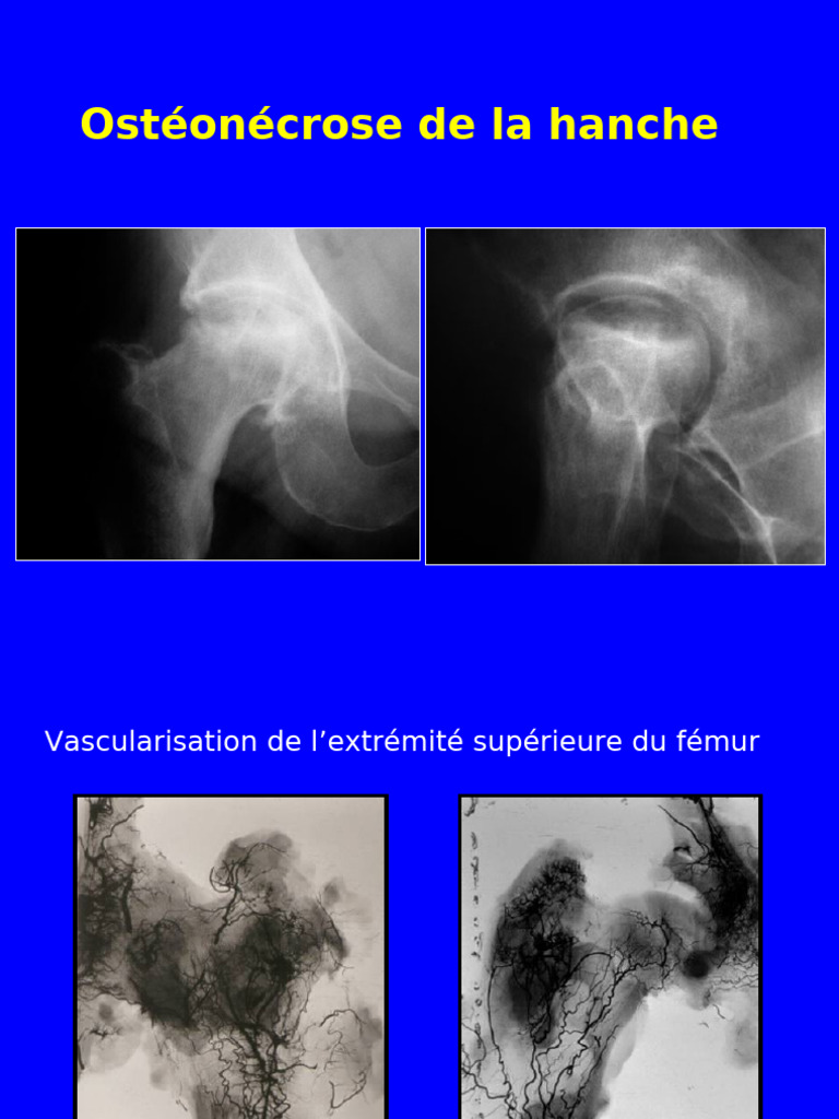 06 - Necrose de La Hanche | PDF