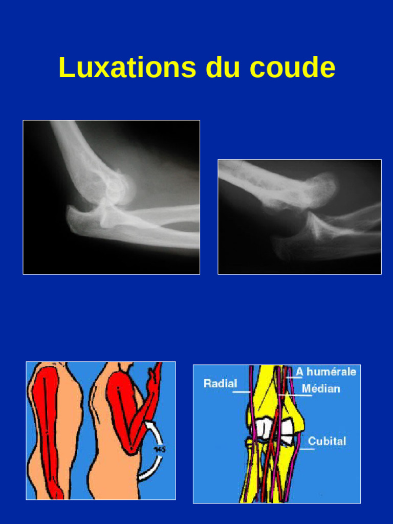 10 - Coude Luxation - Fract Olecrane, Radius | PDF