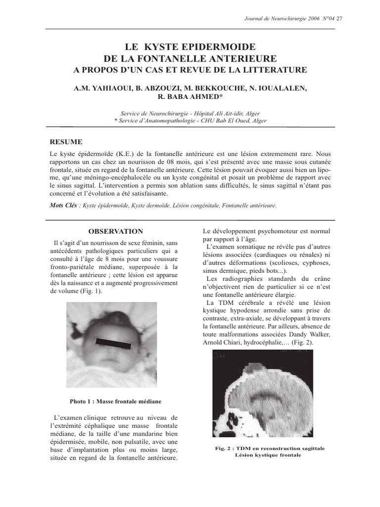 Le Kyste Epidermoide de La Fontanelle Anterieure A Propos D'un Cas Et ...