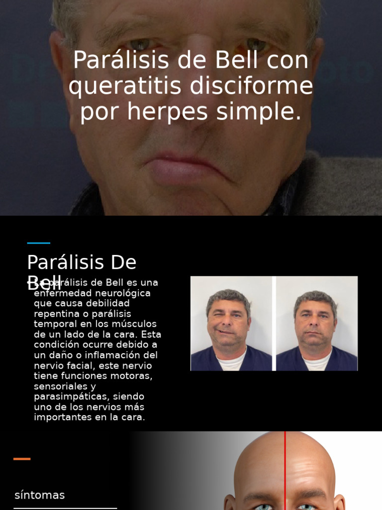 Parálisis de Bell Con Queratitis Disciforme Por Herpes | PDF