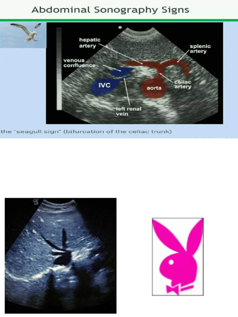 Sonographic Signs | PDF