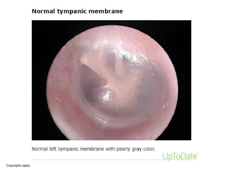 Normal Tympanic Membrane | PDF
