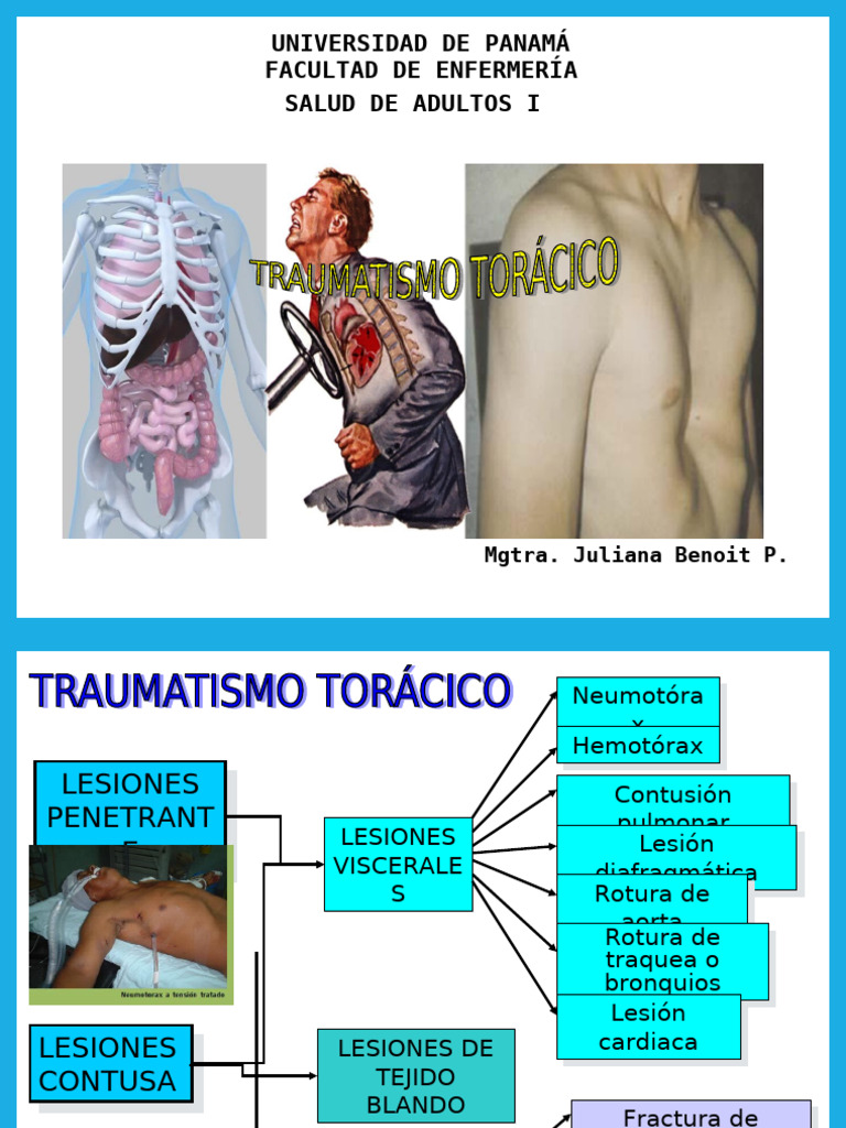 Traumatismo Torácico | PDF
