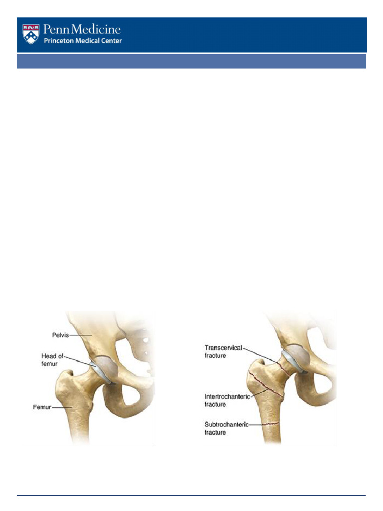 Patient-Education On Hip-Fracture | PDF | Surgery | Wellness
