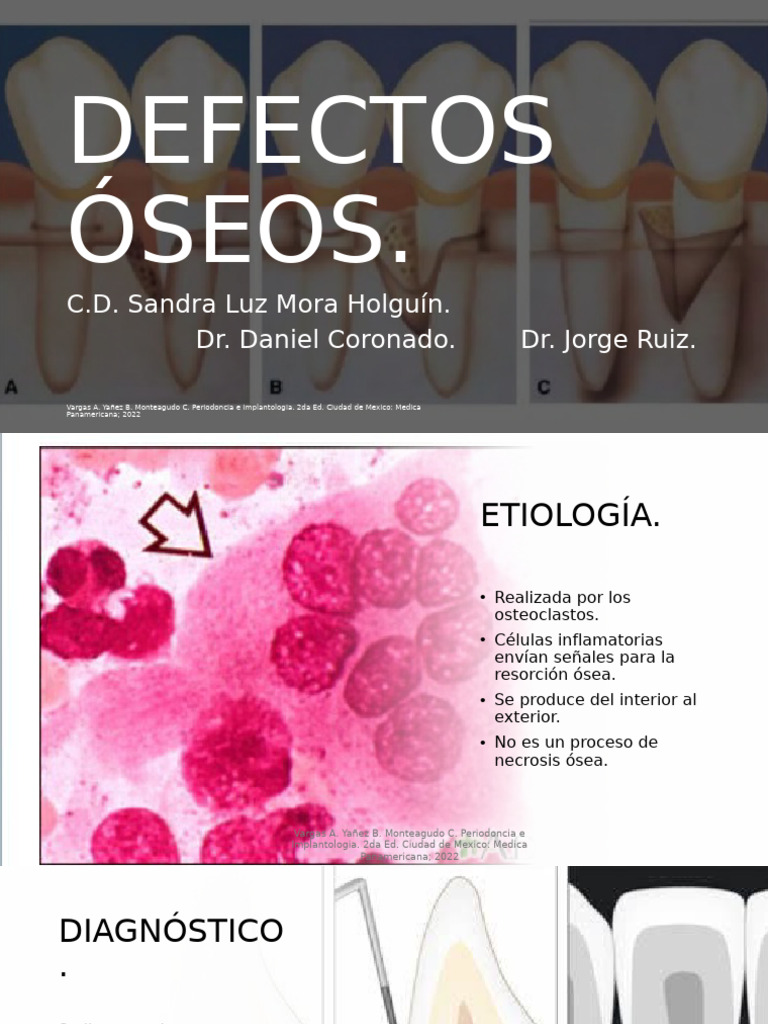 Defectos Óseos | PDF