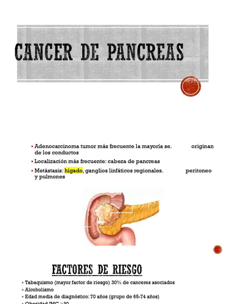Cancer de Páncreas | PDF