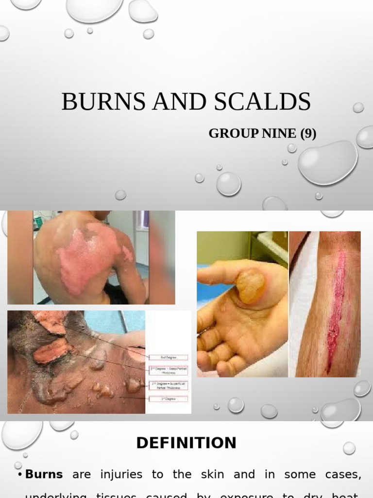 Burns and Scalds | PDF | Burn | Steam