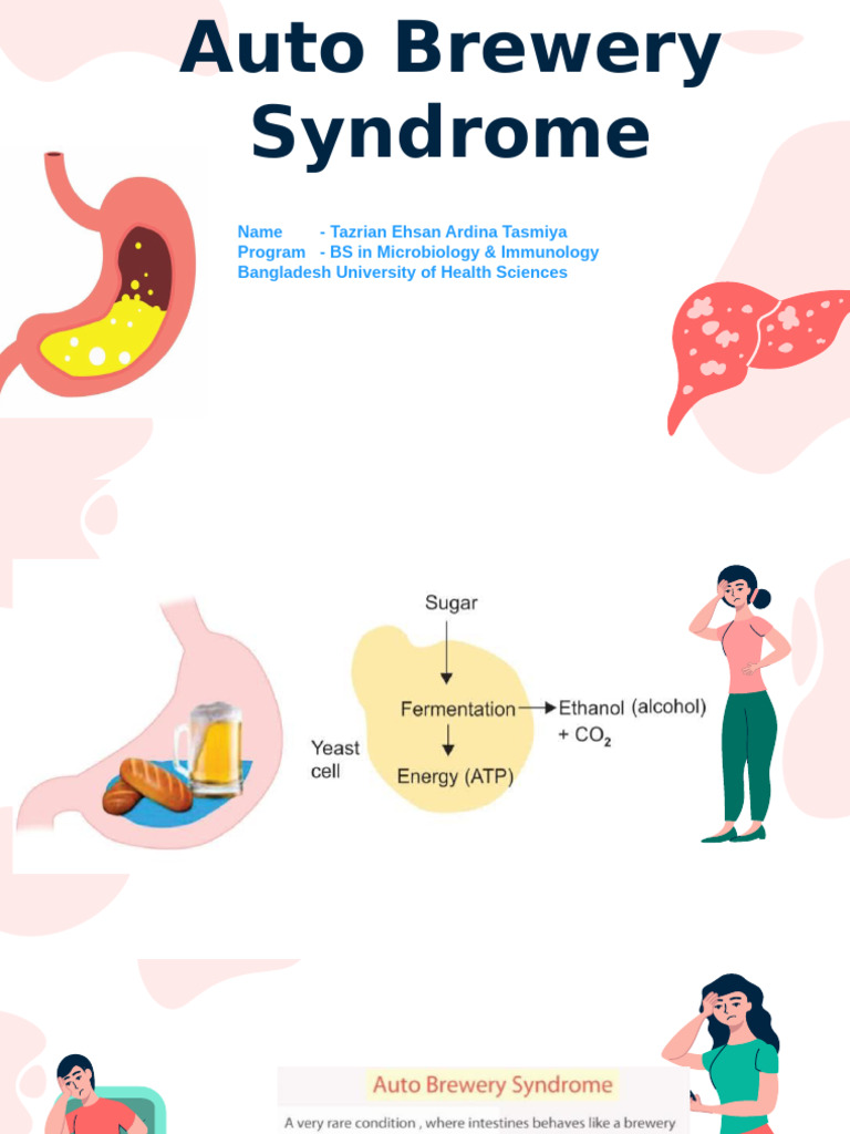 Auto Brewery Syndrome Tasmiya Buhs | PDF