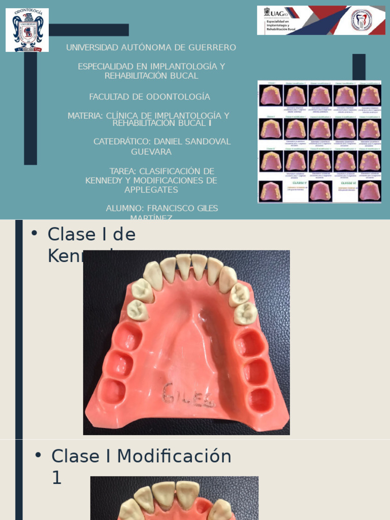 Clasificaciones de Kennedy y Modificaciones | PDF