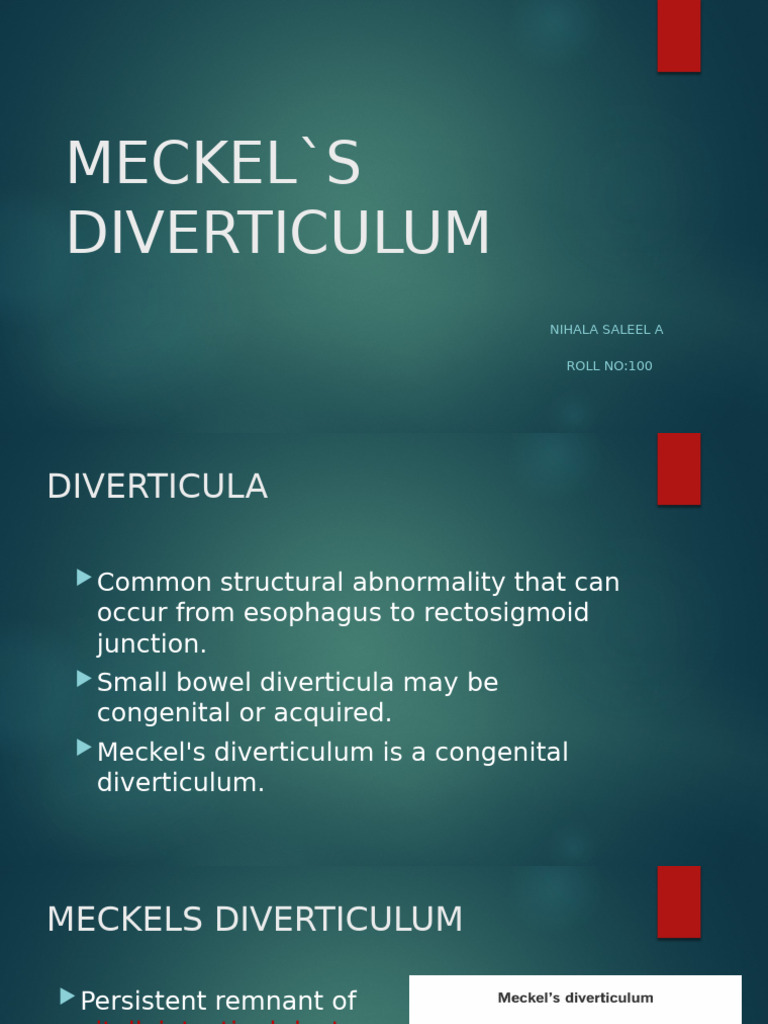 Meckel's Diverticulum . | PDF