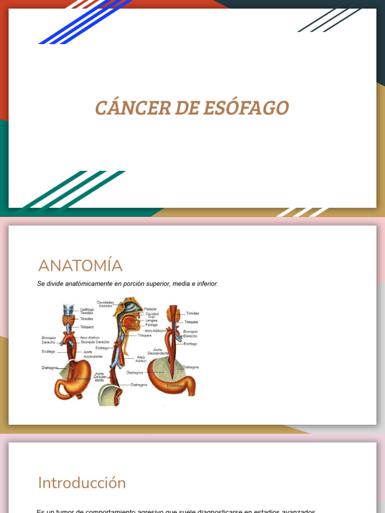 Cancer Esofago | PDF | Cáncer de esófago | Cáncer