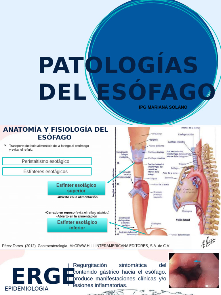 Esofagitis | PDF