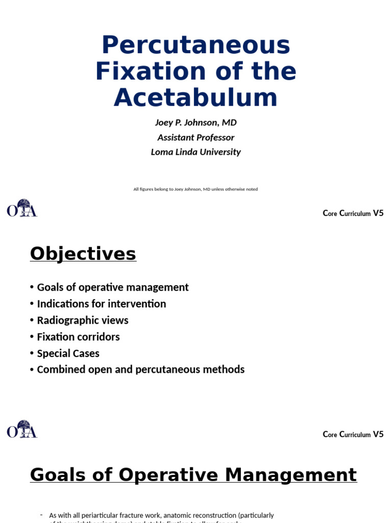 Percutaneous Fixation of The Acetabulum: Joey P. Johnson, MD Assistant ...