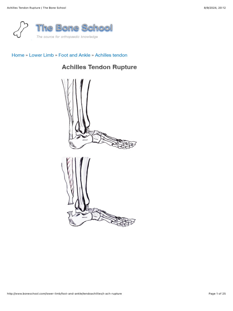 Achilles Tendon Rupture - The Bone School | PDF | Limbs (Anatomy ...