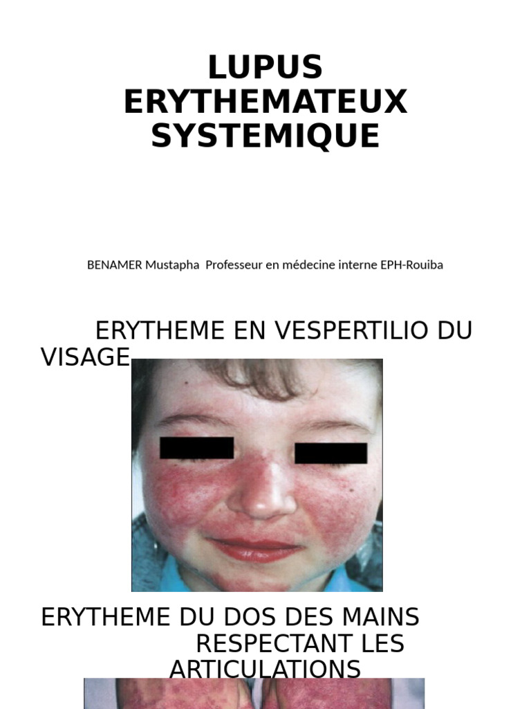 Lupus Erythemateux Systemique | PDF