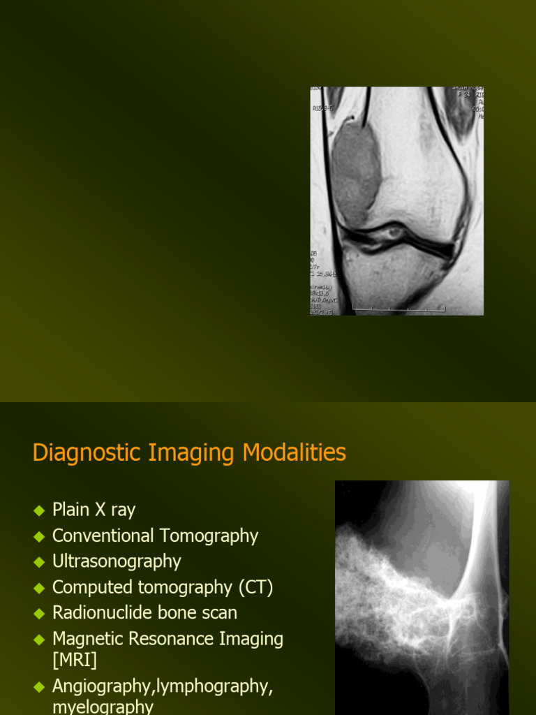 Bone Tumours Prof Dr Mamdouh Mahfoz Pdf