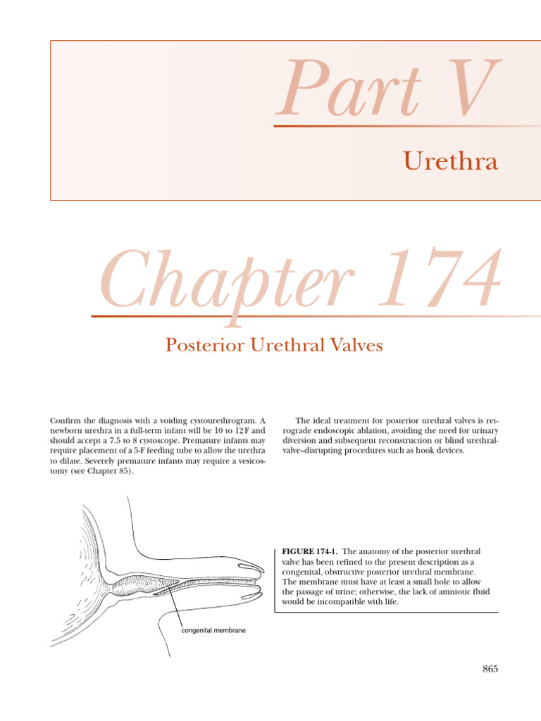 Chapter174 PosteriorUrethralValves | PDF | Medical Specialties ...